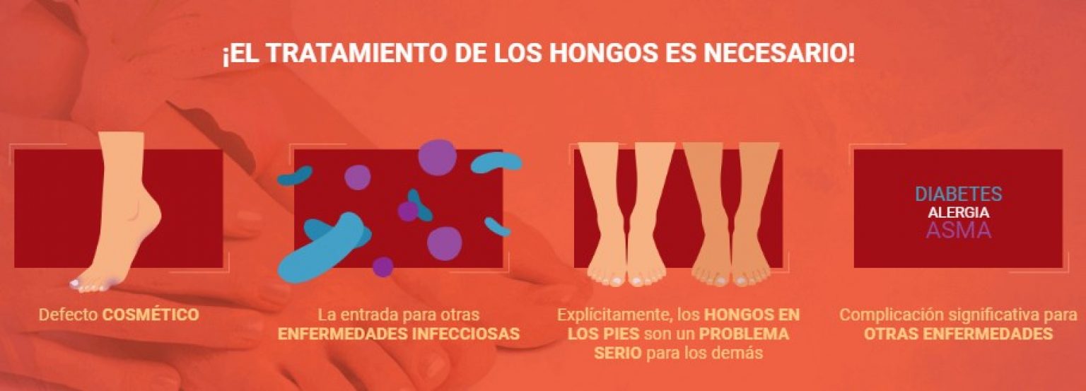 Keraderm: o como eliminar los hongos de tus pies ¿Dónde comprar ...