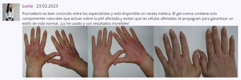Psoriaderm crema para la psoriasis – precio en farmacias, opiniones ...